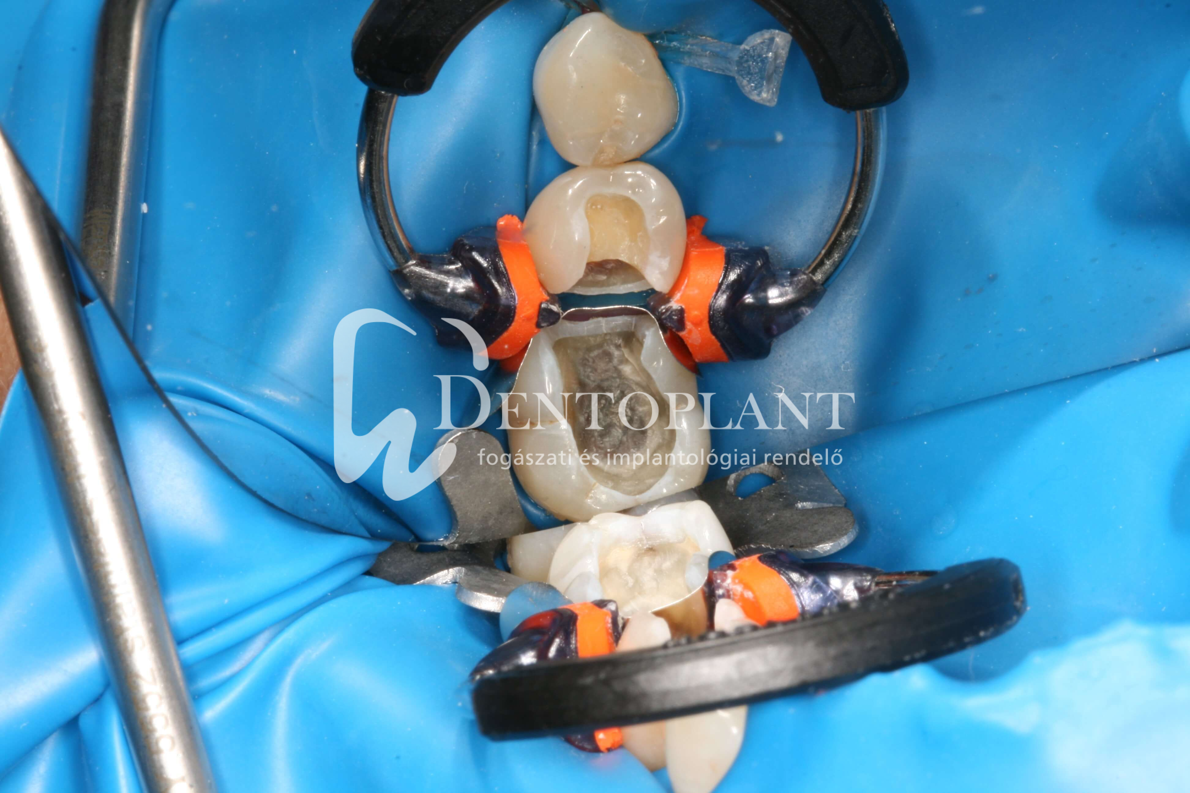 Gyökérkezelt, sérült fogak megmentése csapozással és modern ...