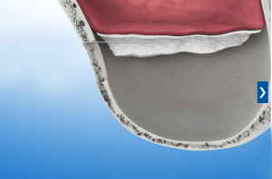 Speciális csontpótlás a felső állcsonton, avagy arcüreg emelés, sinus ...